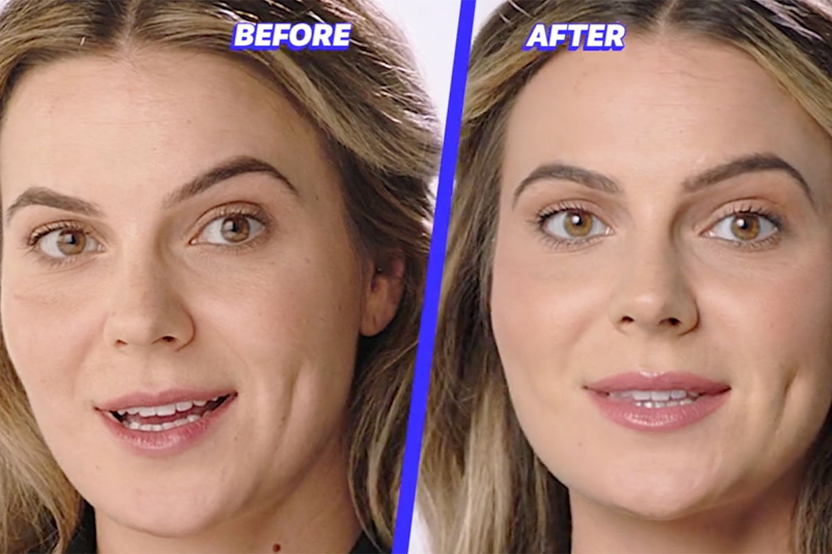 Juvederm in Chantilly, VA | Flawless Skincare and Aesthetics